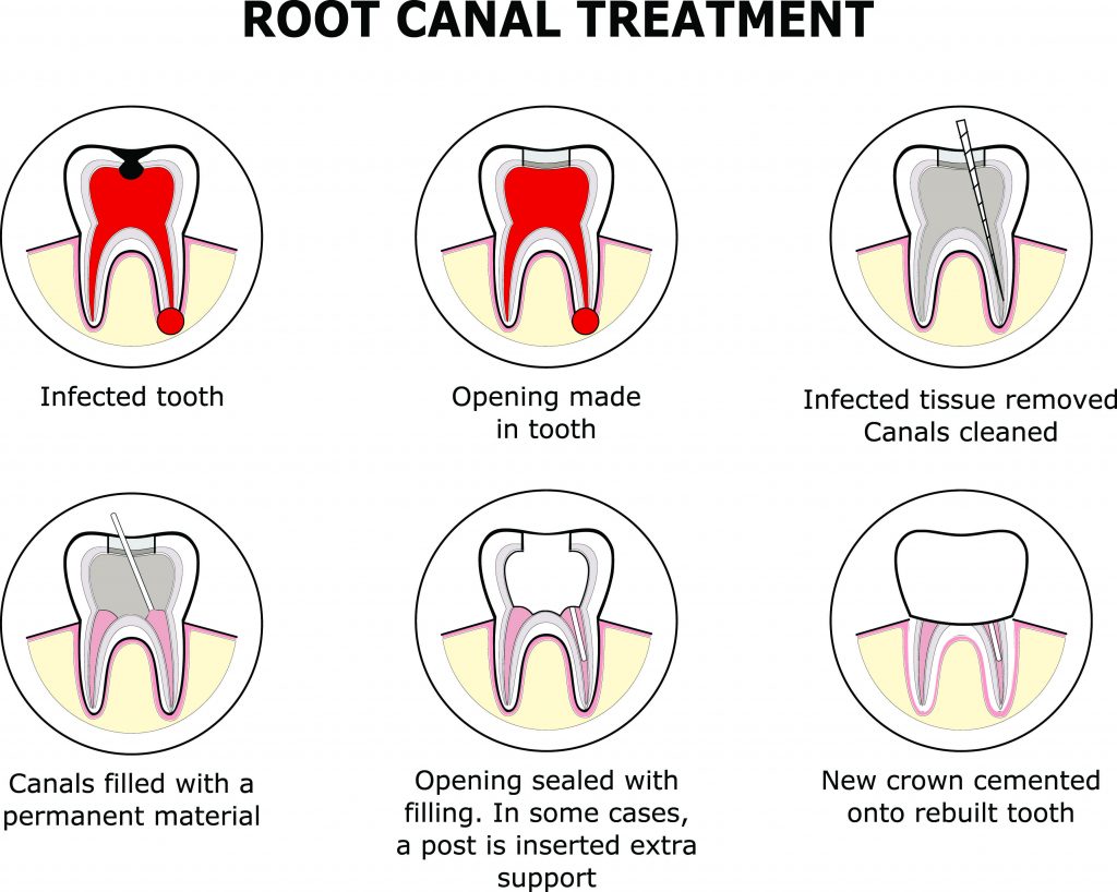 Root canal treatment – Pure Bliss Dental Care